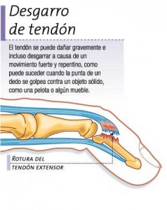 Desgarro de tendón - Icarito